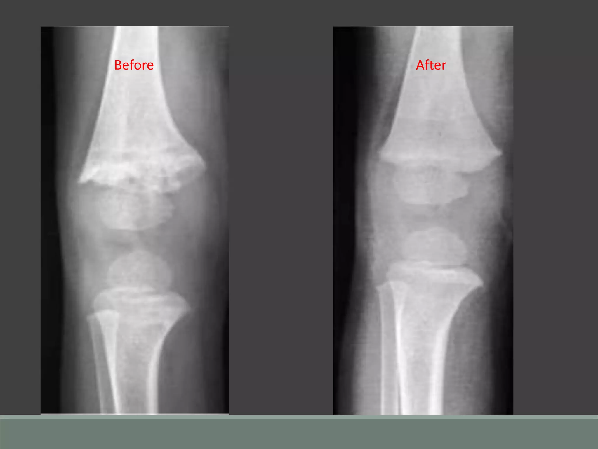 Imaging in rickets | PPTX