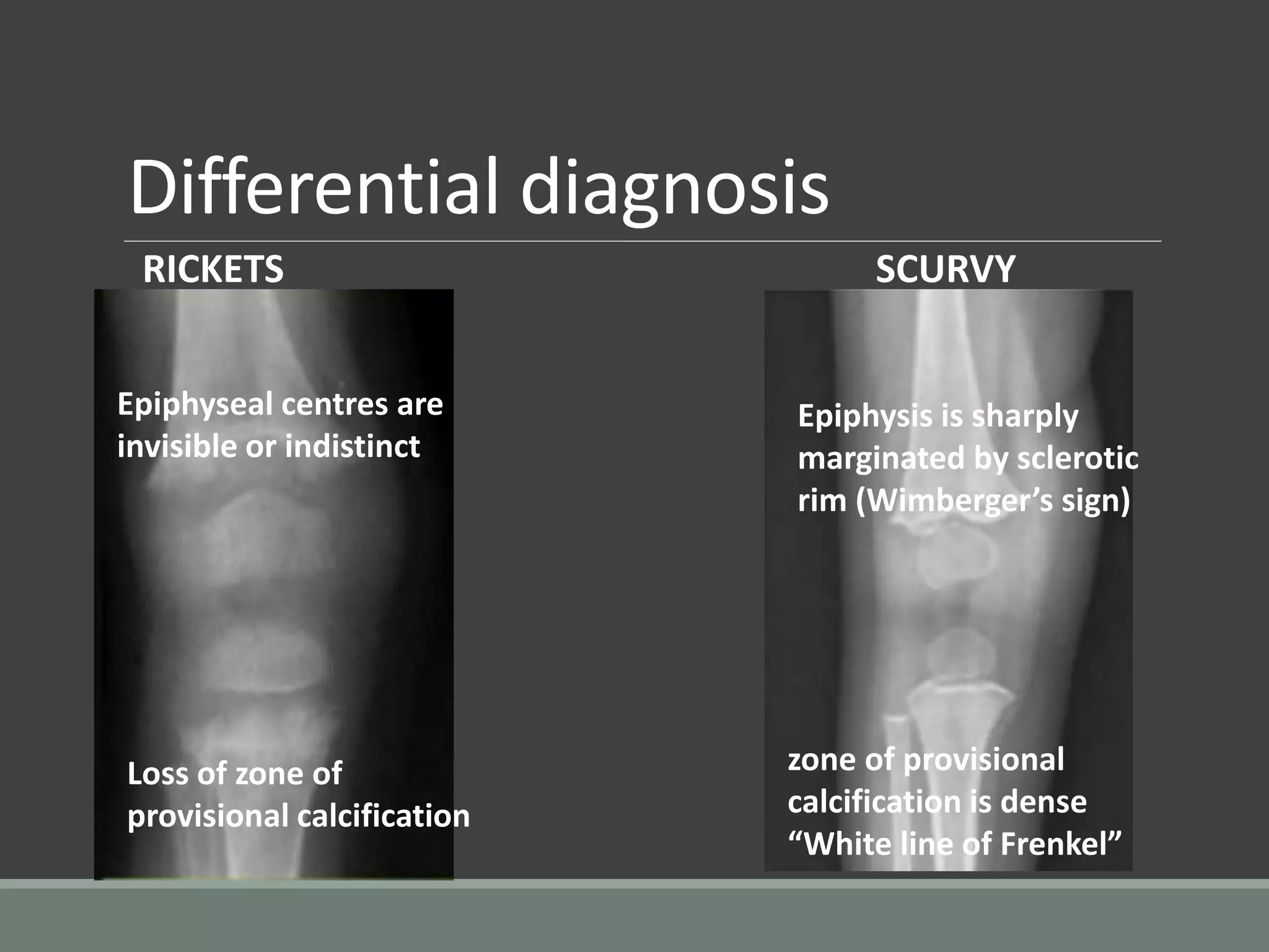 Imaging in rickets | PPTX