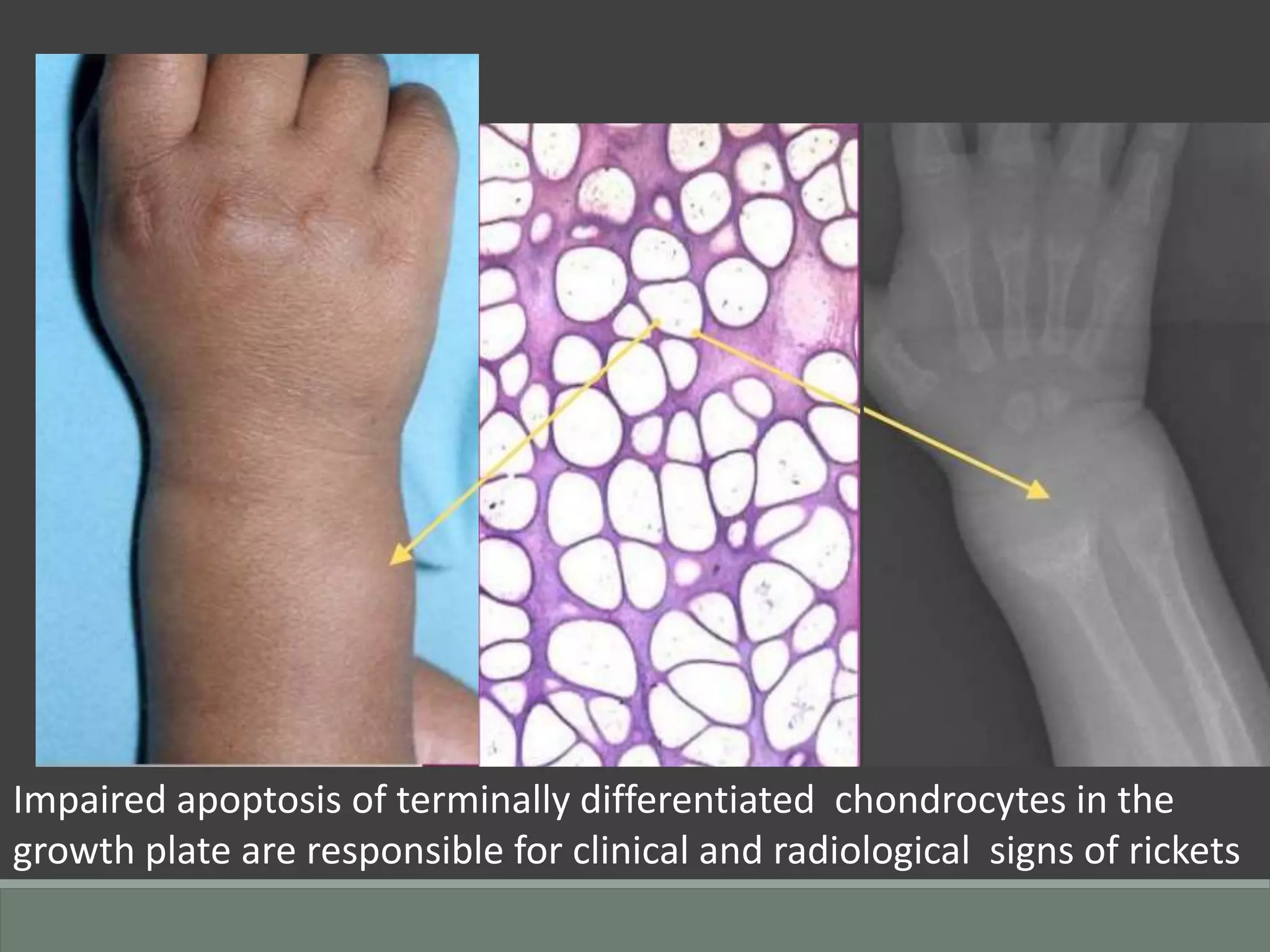 Imaging in rickets | PPTX | Bone and Joint Conditions | Diseases and ...