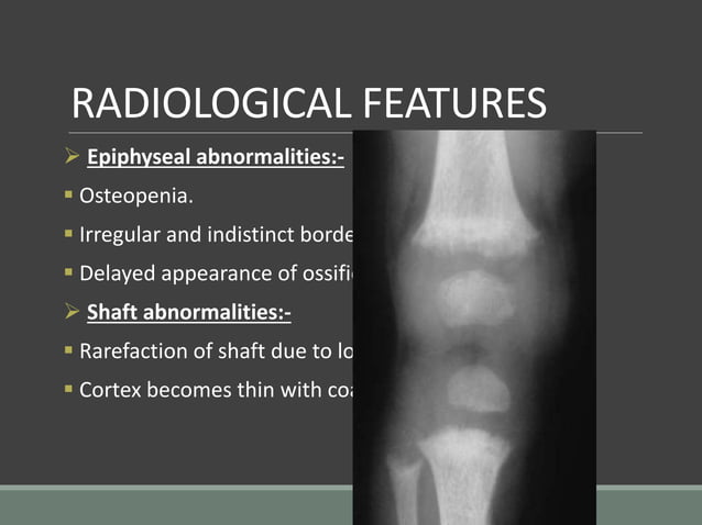 Imaging in rickets | PPTX | Bone and Joint Conditions | Diseases and ...