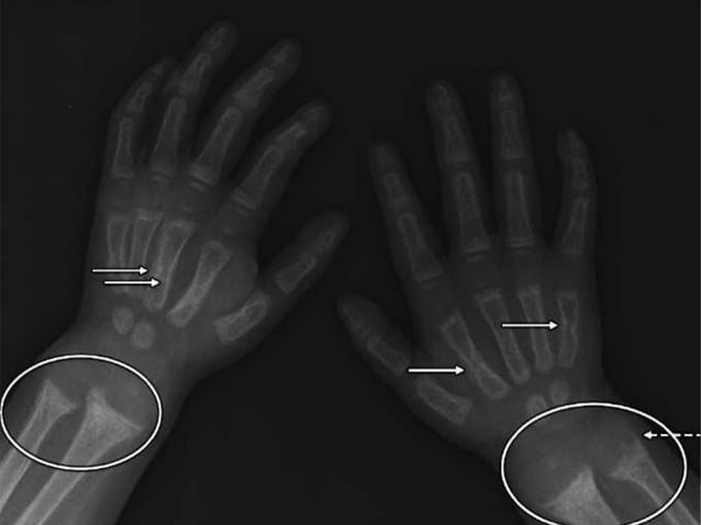 Imaging in rickets | PPTX | Bone and Joint Conditions | Diseases and ...