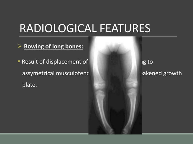 Imaging in rickets | PPTX | Bone and Joint Conditions | Diseases and ...