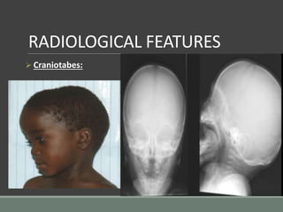 Imaging in rickets | PPTX