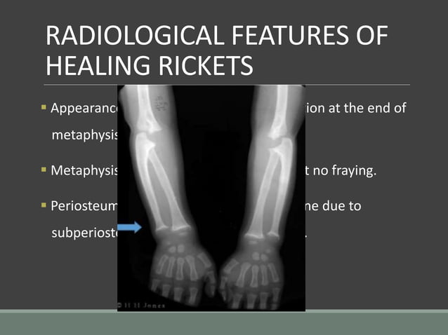 Imaging in rickets | PPTX | Bone and Joint Conditions | Diseases and ...