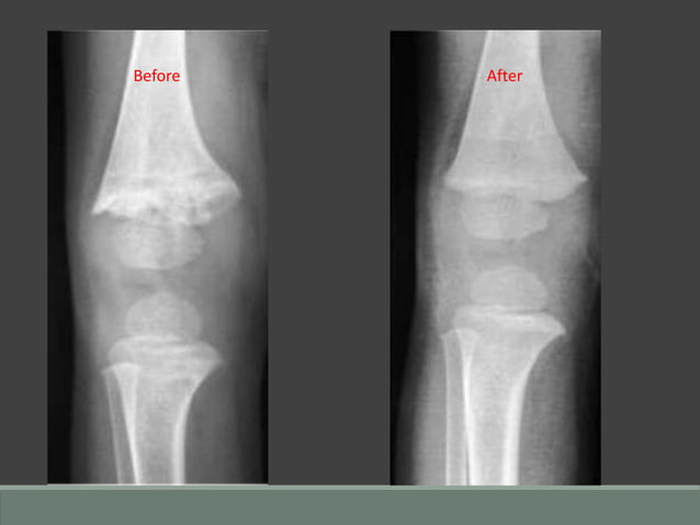 Imaging in rickets | PPTX | Bone and Joint Conditions | Diseases and ...