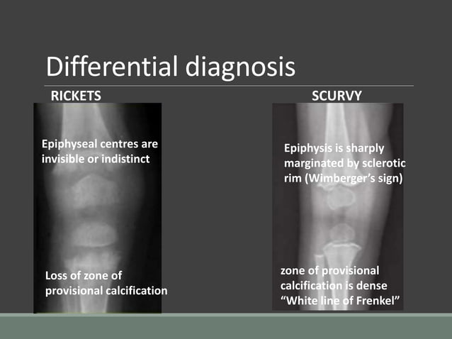 Imaging in rickets | PPTX | Bone and Joint Conditions | Diseases and ...
