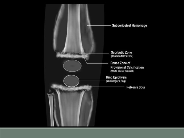Imaging in rickets | PPTX | Bone and Joint Conditions | Diseases and ...