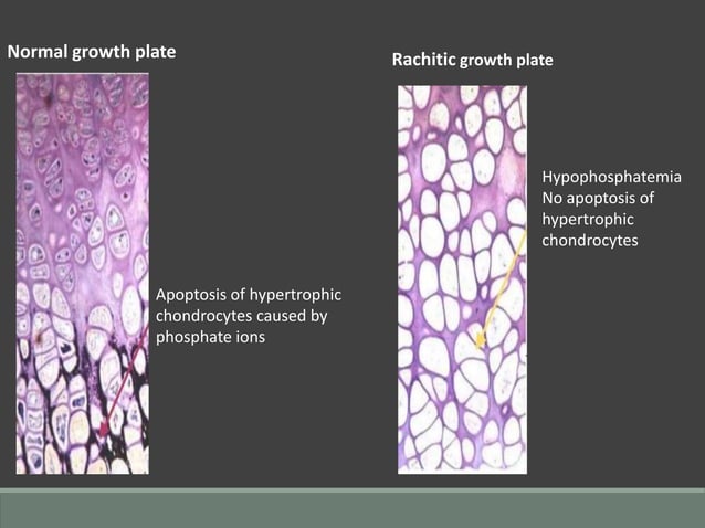 Imaging in rickets | PPTX | Bone and Joint Conditions | Diseases and ...