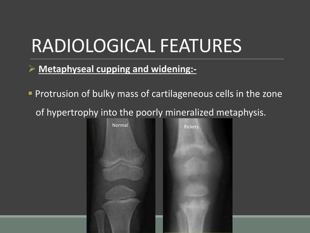 Imaging in rickets | PPTX | Bone and Joint Conditions | Diseases and ...
