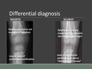 Imaging in rickets | PPT