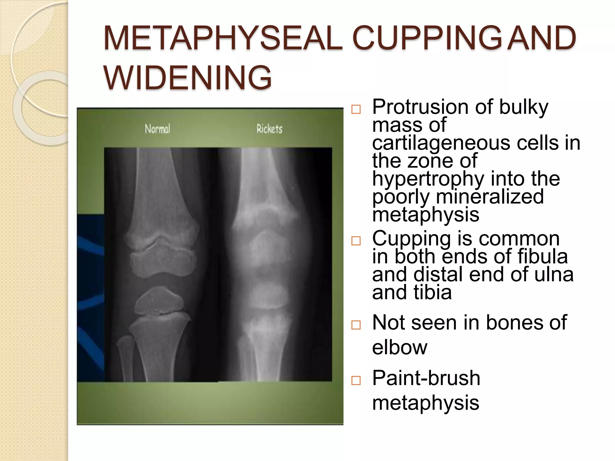 Imaging in Rickets & Scurvy.pptx