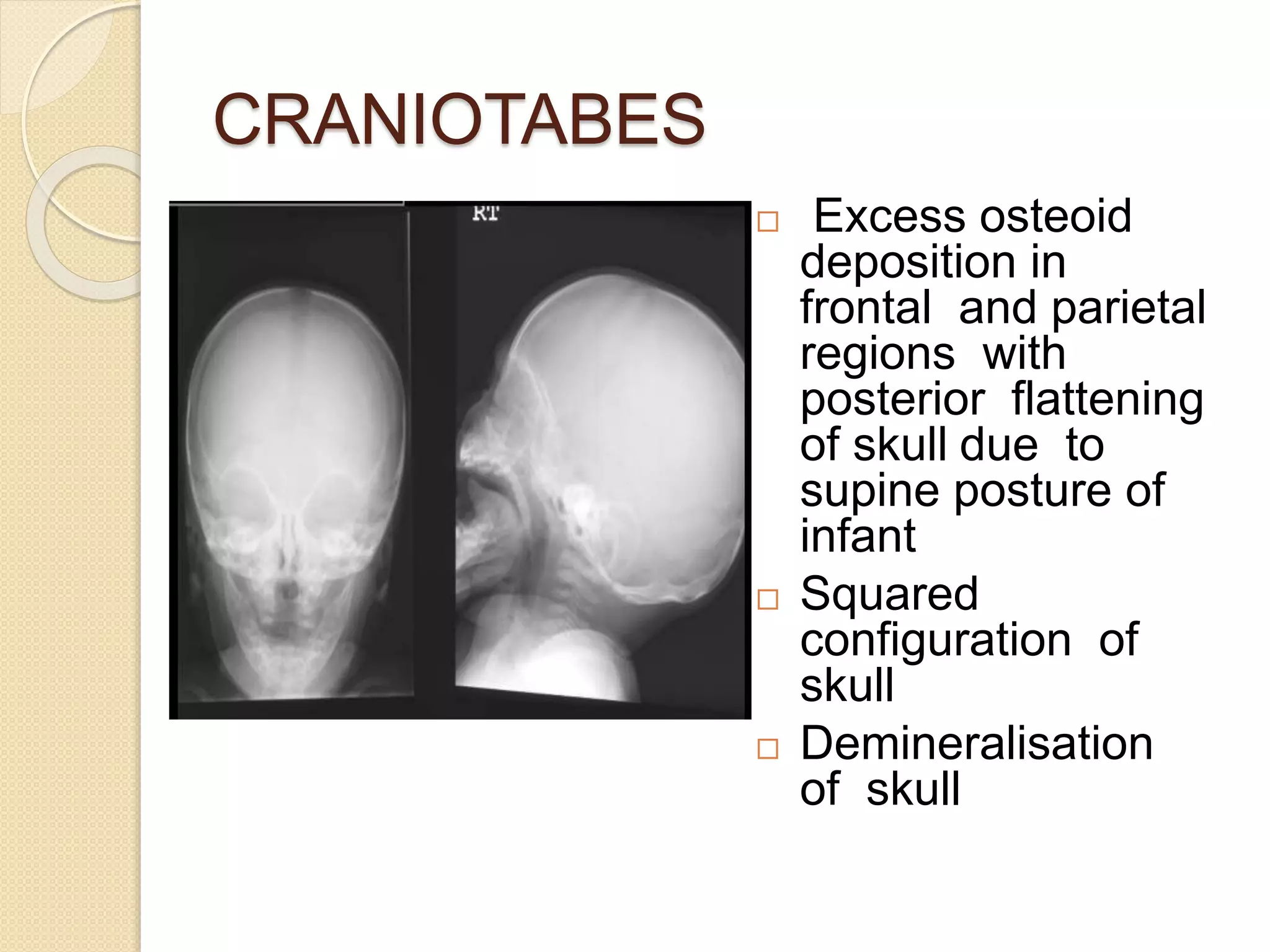 Imaging in Rickets & Scurvy.pptx