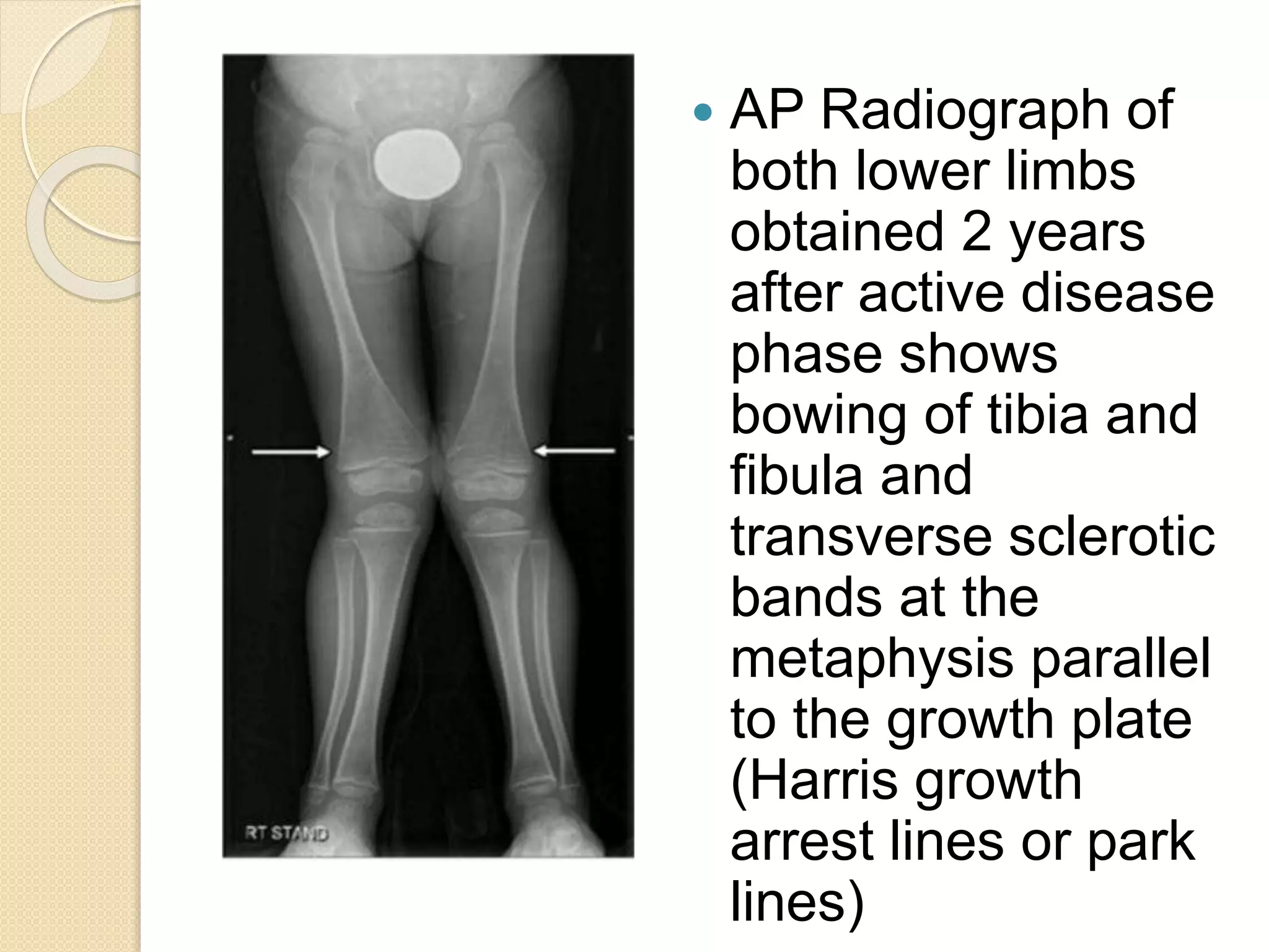 Imaging in Rickets & Scurvy.pptx