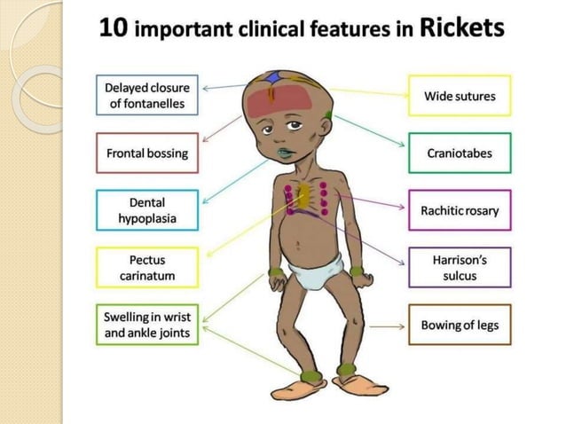 Imaging in Rickets & Scurvy.pptx