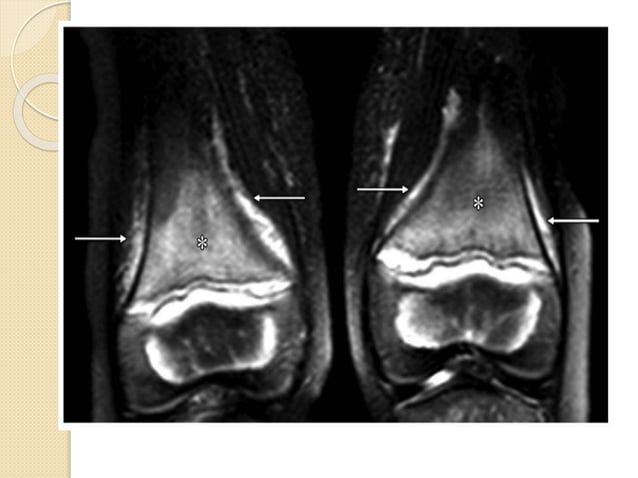 Imaging in Rickets & Scurvy.pptx