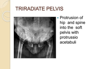 Triradiate Pelvis