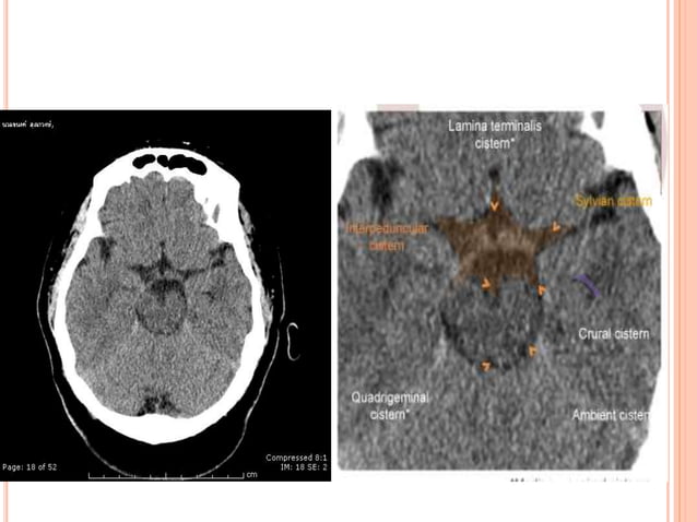 Imaging in SAH | PPTX | Blood Disorders | Diseases and Conditions
