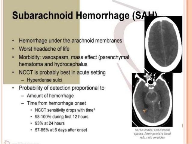 Imaging in SAH