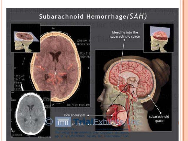 Imaging in SAH