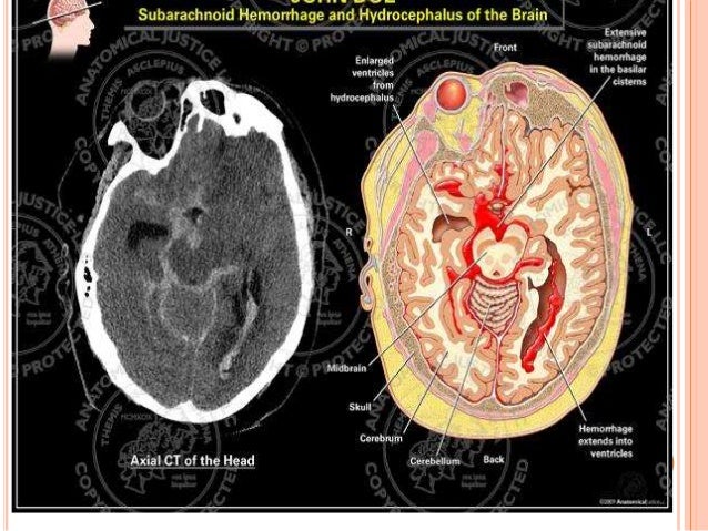 Imaging in SAH