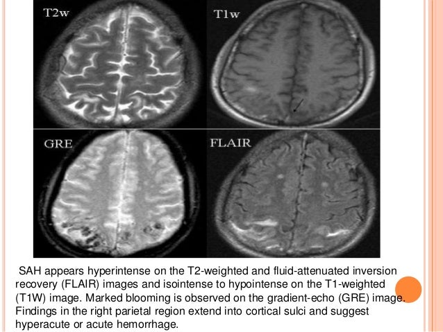 Imaging in SAH