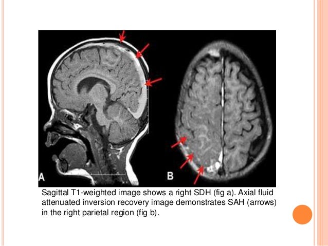 Imaging in SAH