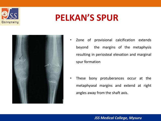Imaging in scurvy | PPTX