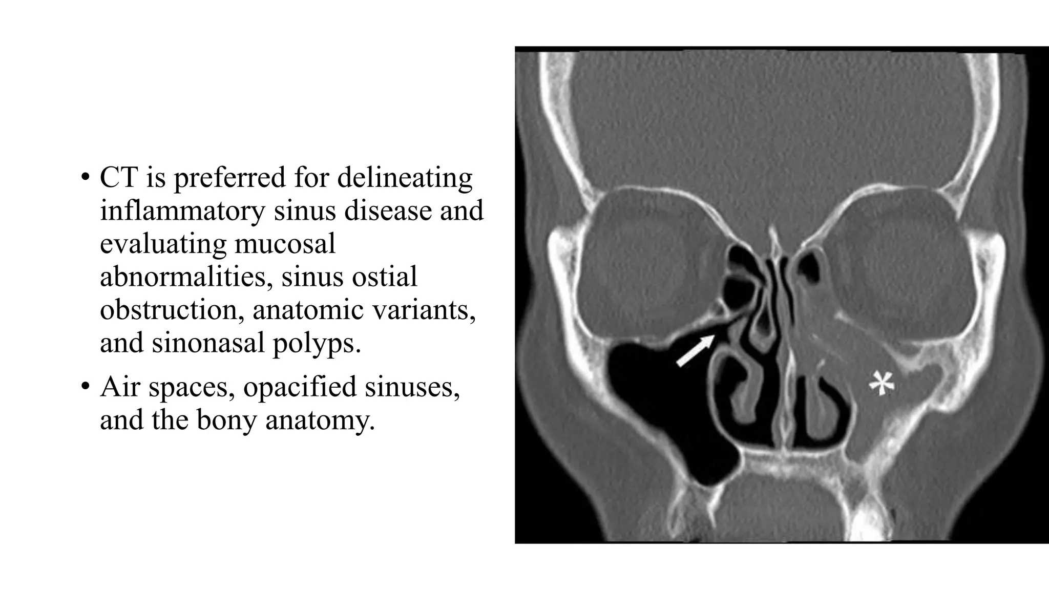 Imaging in sinusitis radio diagnosis | PPT