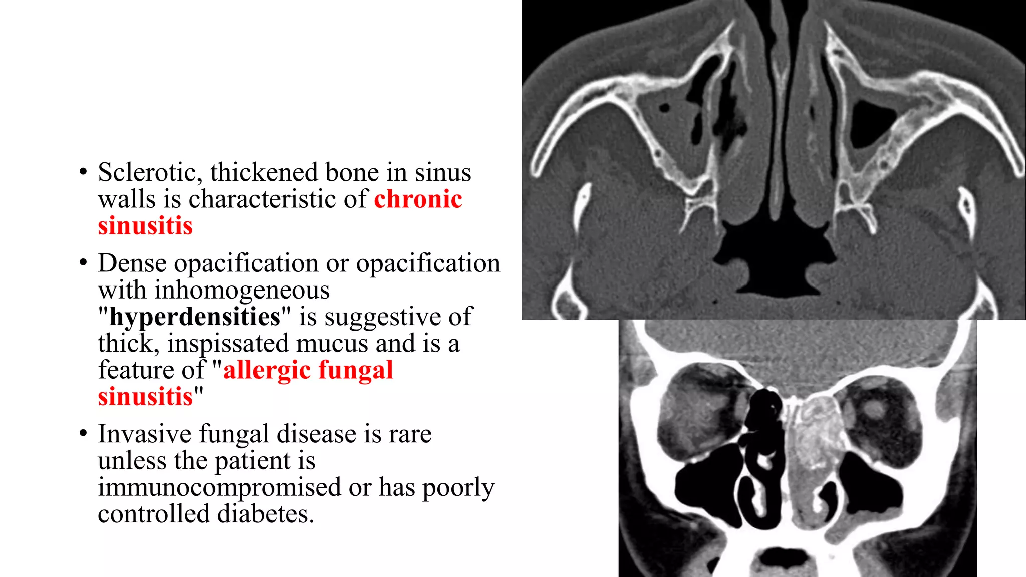 Imaging in sinusitis radio diagnosis | PPT