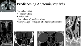 Imaging in sinusitis radio diagnosis | PPTX