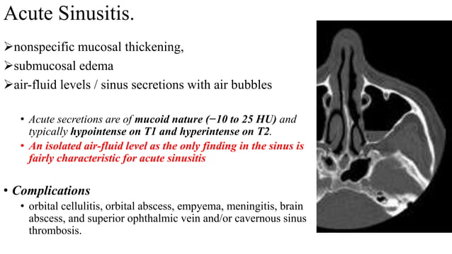 Imaging in sinusitis radio diagnosis | PPT