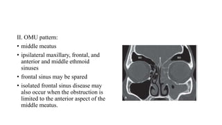 Imaging in sinusitis radio diagnosis | PPT