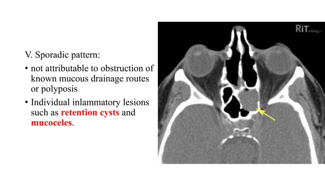 Imaging in sinusitis radio diagnosis | PPT