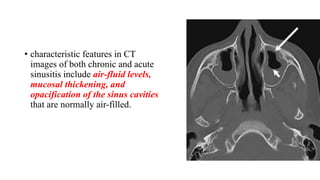 Imaging in sinusitis radio diagnosis | PPT