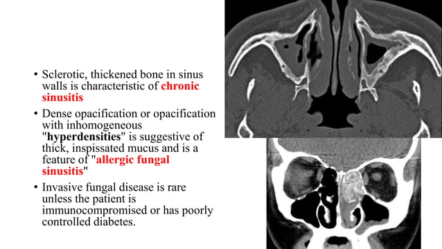 Imaging in sinusitis radio diagnosis | PPT