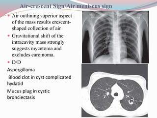 Imaging in solitary pulmonary nodule ppt | PPTX