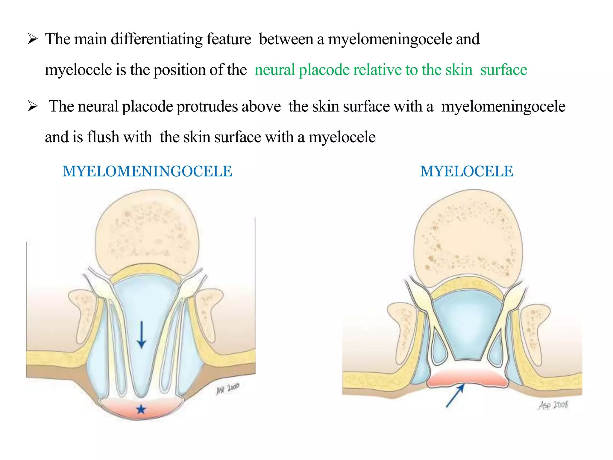 Imaging in spinal dysraphism | PPTX