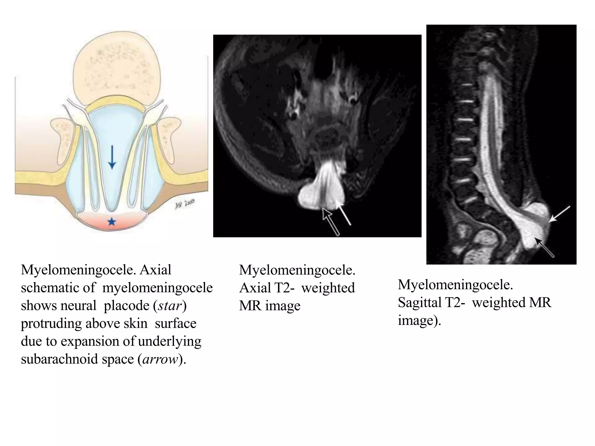 Imaging in spinal dysraphism | PPTX