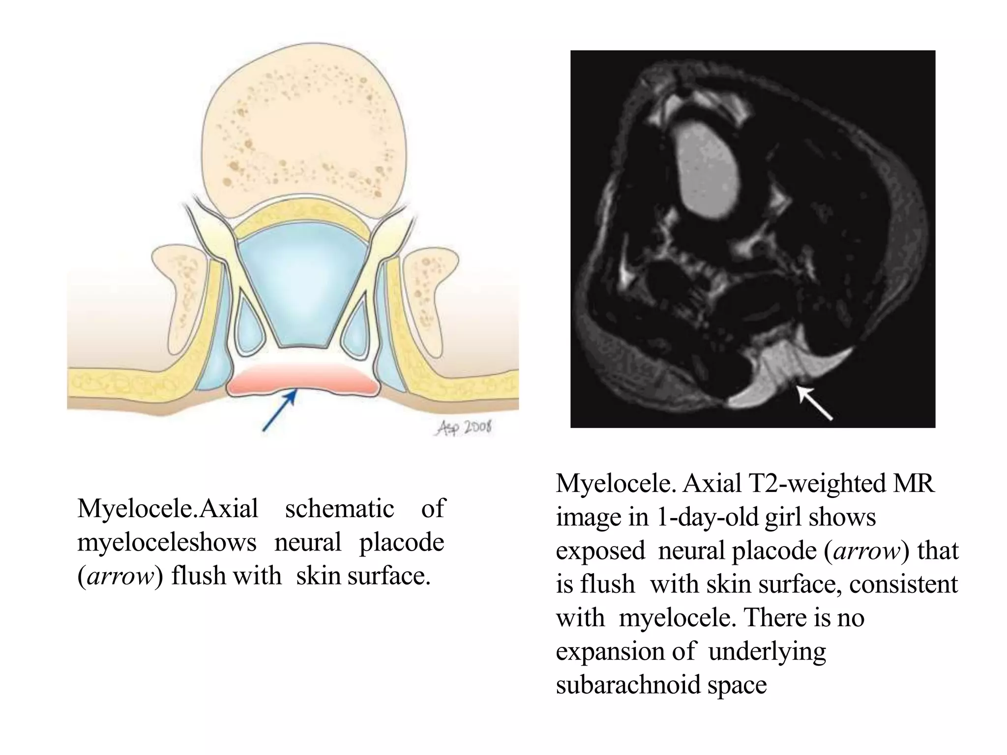 Imaging in spinal dysraphism | PPTX