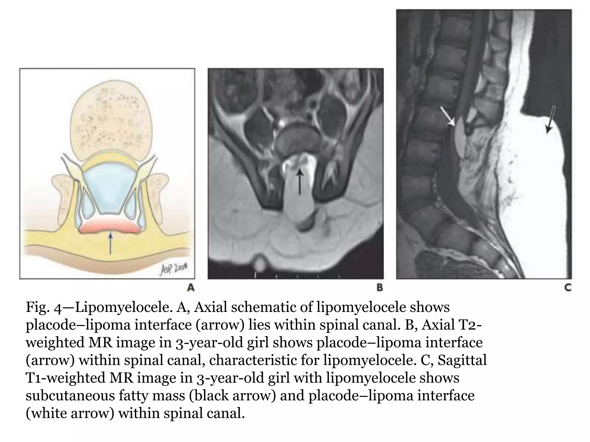 Imaging in spinal dysraphism | PPTX | Brain and Nervous System ...