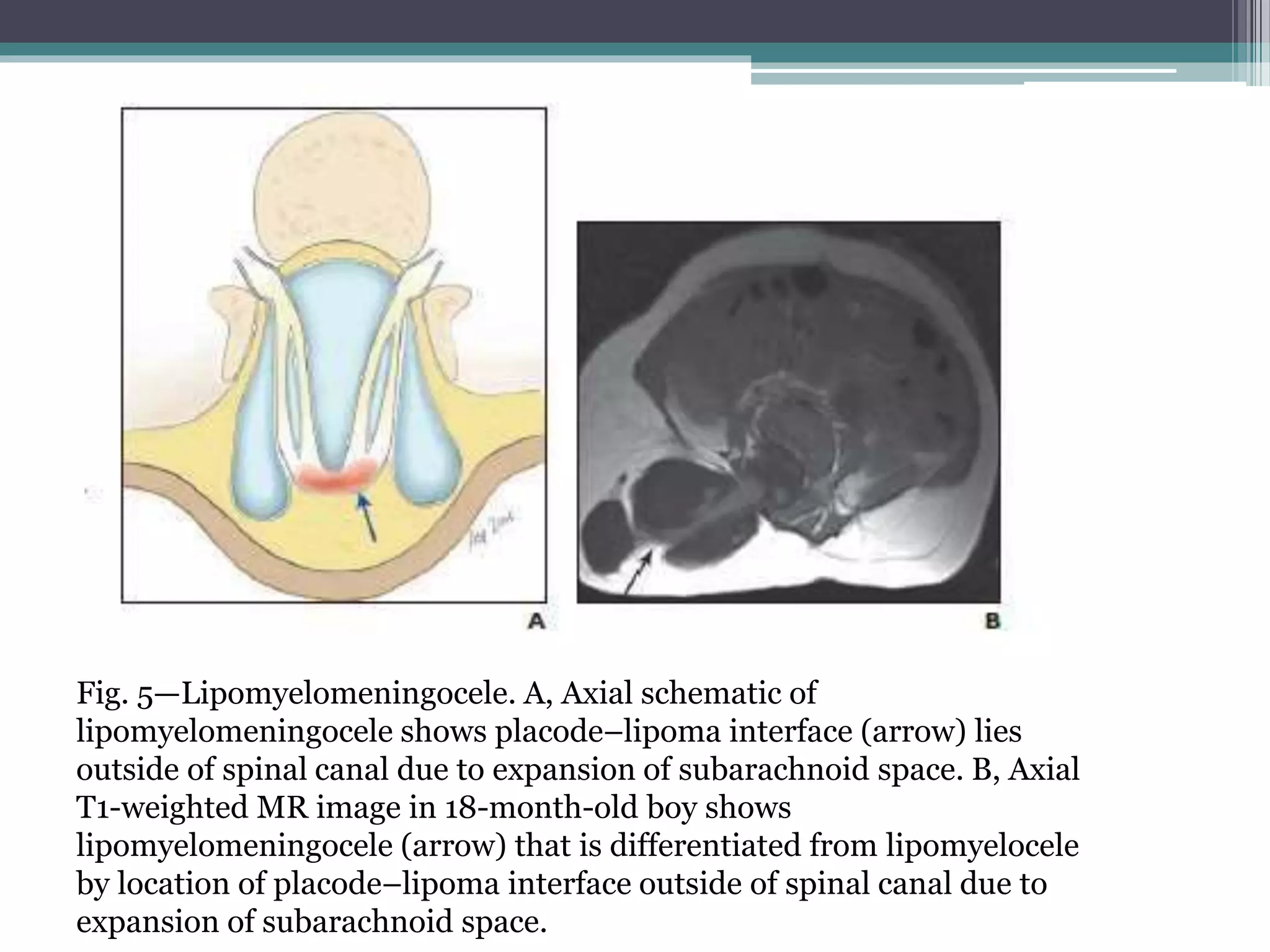 Imaging in spinal dysraphism | PPTX