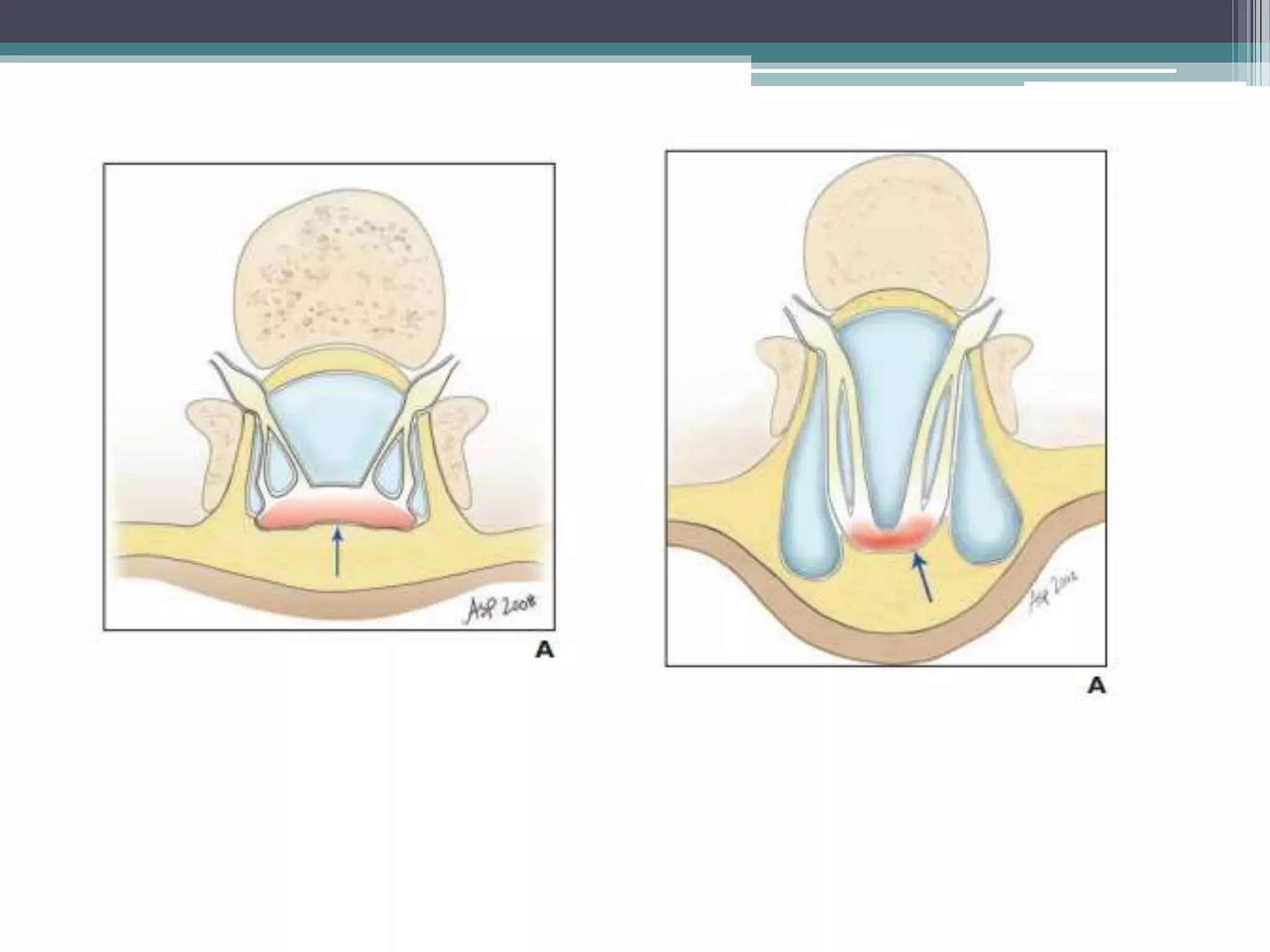 Imaging in spinal dysraphism | PPTX
