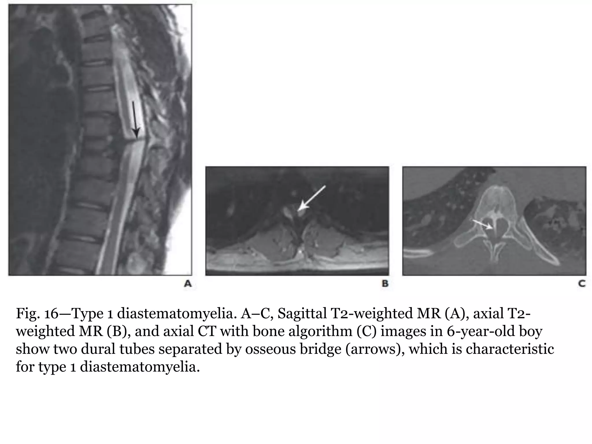 Imaging in spinal dysraphism | PPTX