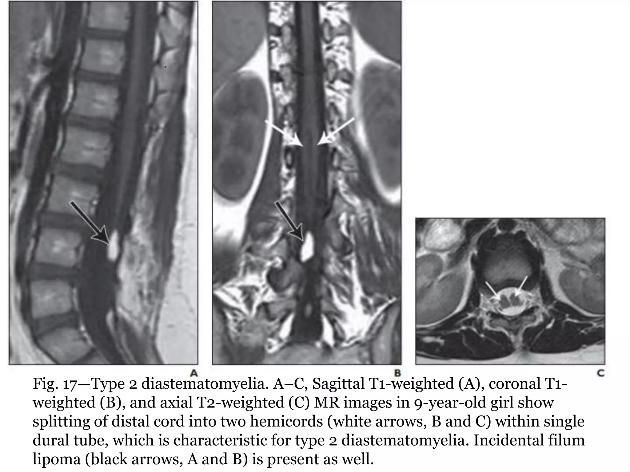 Imaging in spinal dysraphism | PPTX