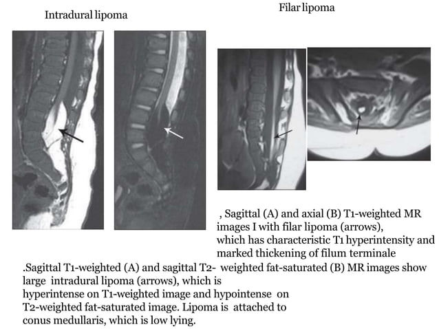 Imaging in spinal dysraphism | PPTX | Brain and Nervous System ...