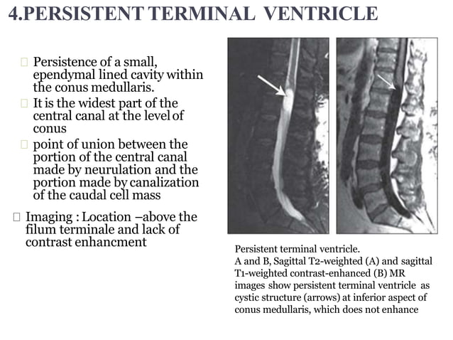 Imaging in spinal dysraphism | PPTX | Brain and Nervous System ...