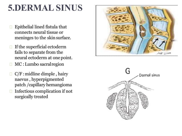 Imaging in spinal dysraphism | PPTX | Brain and Nervous System ...