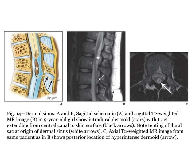 Imaging in spinal dysraphism | PPTX | Brain and Nervous System ...