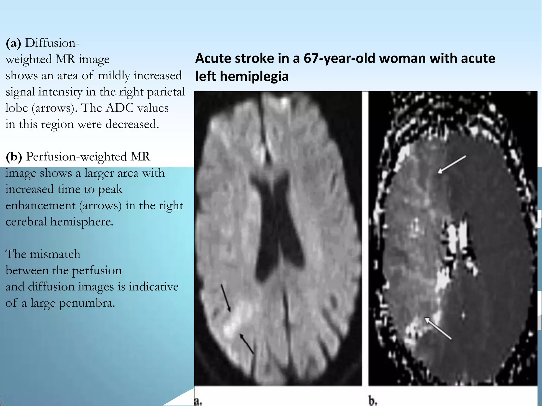 Imaging in stroke | PPTX