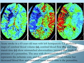 Imaging in stroke | PPTX
